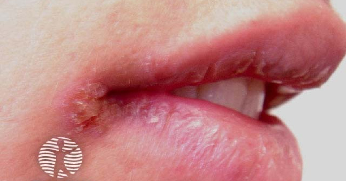 DermNet® - case9 image