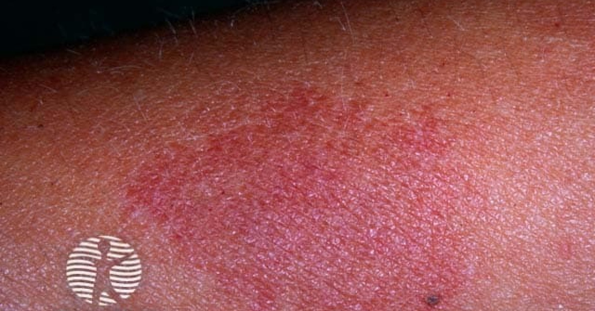 DermNet® - case4a image