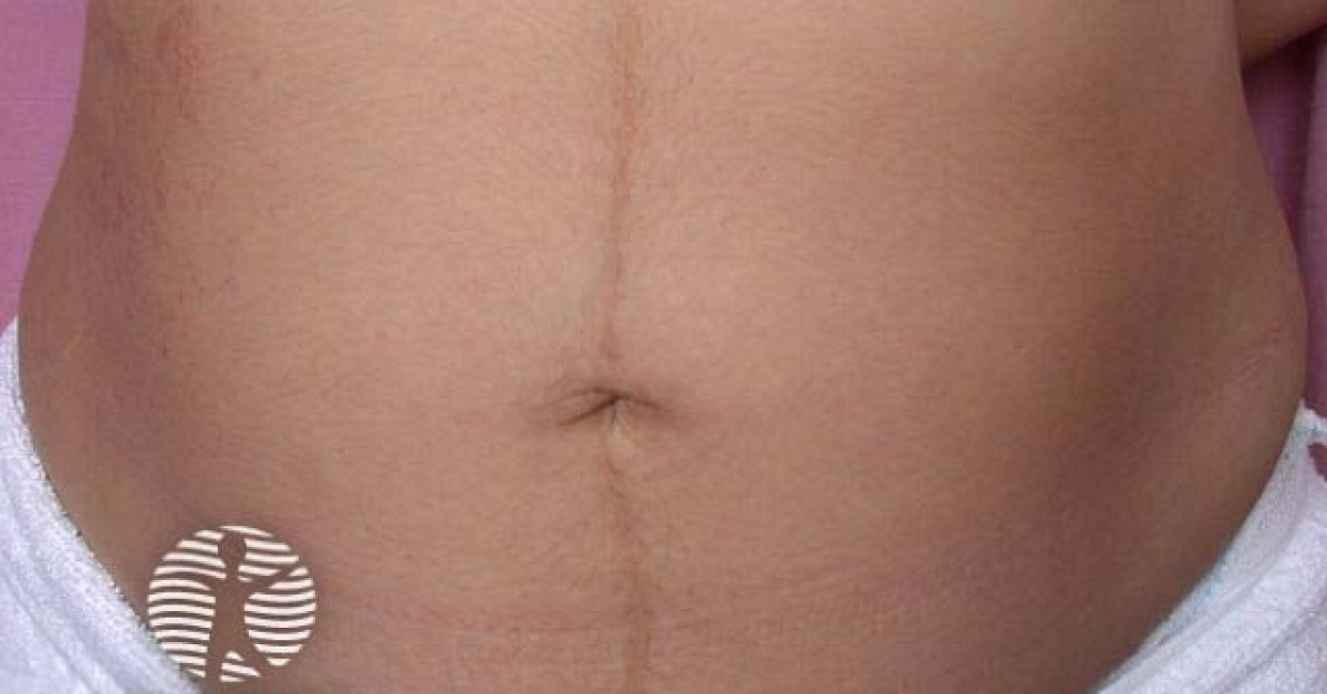 DermNet® - case3 image