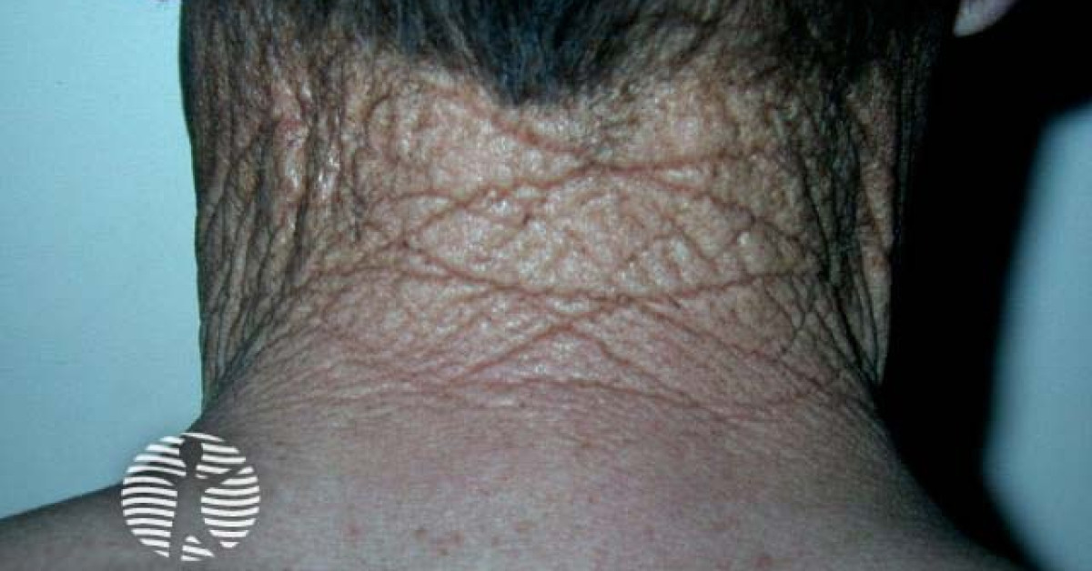 DermNet® - case4 image