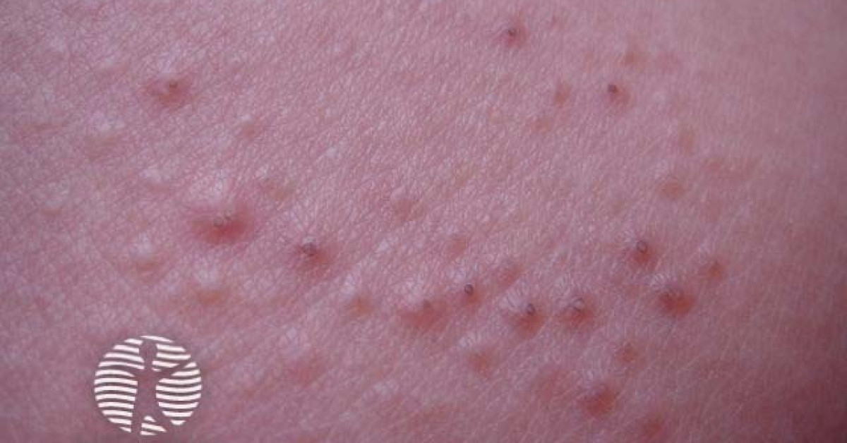 DermNet® - case8 image