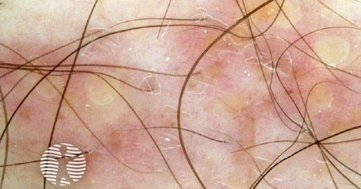 DermNet® - case17b image