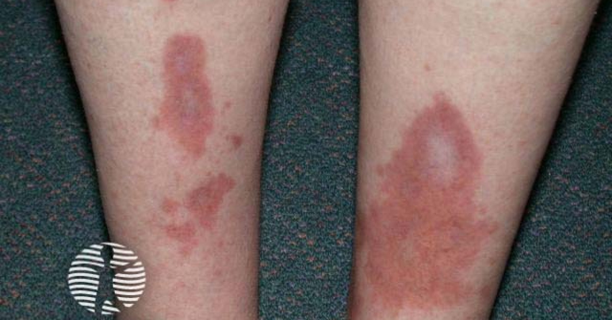 DermNet® - case7 image