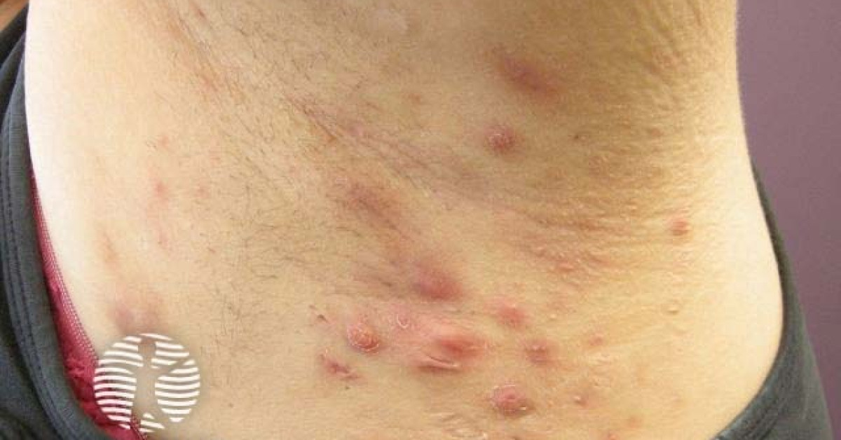 DermNet® - case12 image