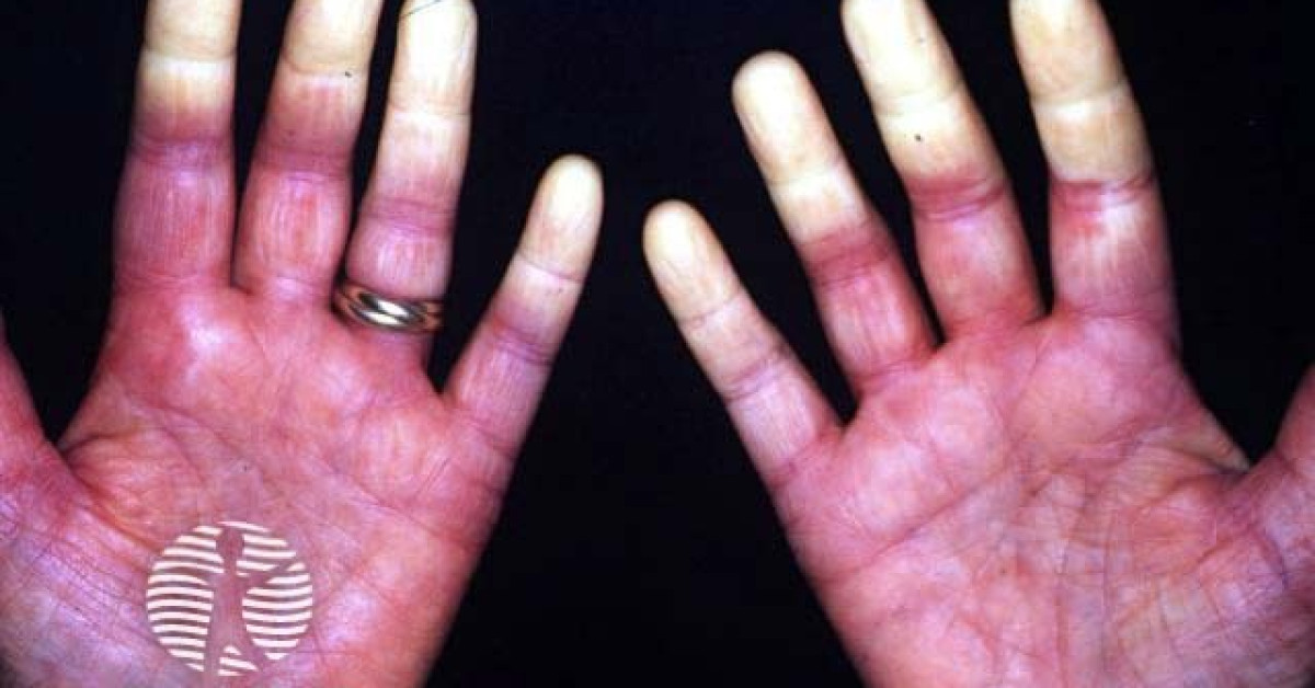 DermNet® - case10 image