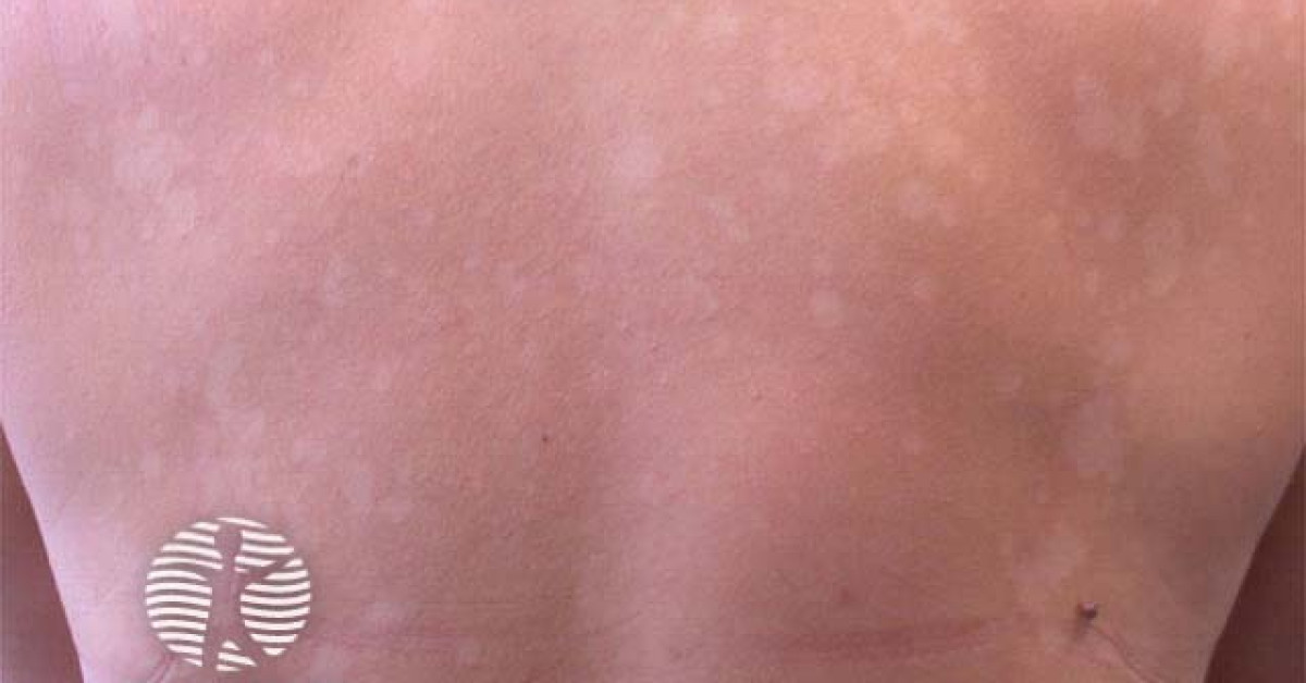 DermNet® - q11c7a image