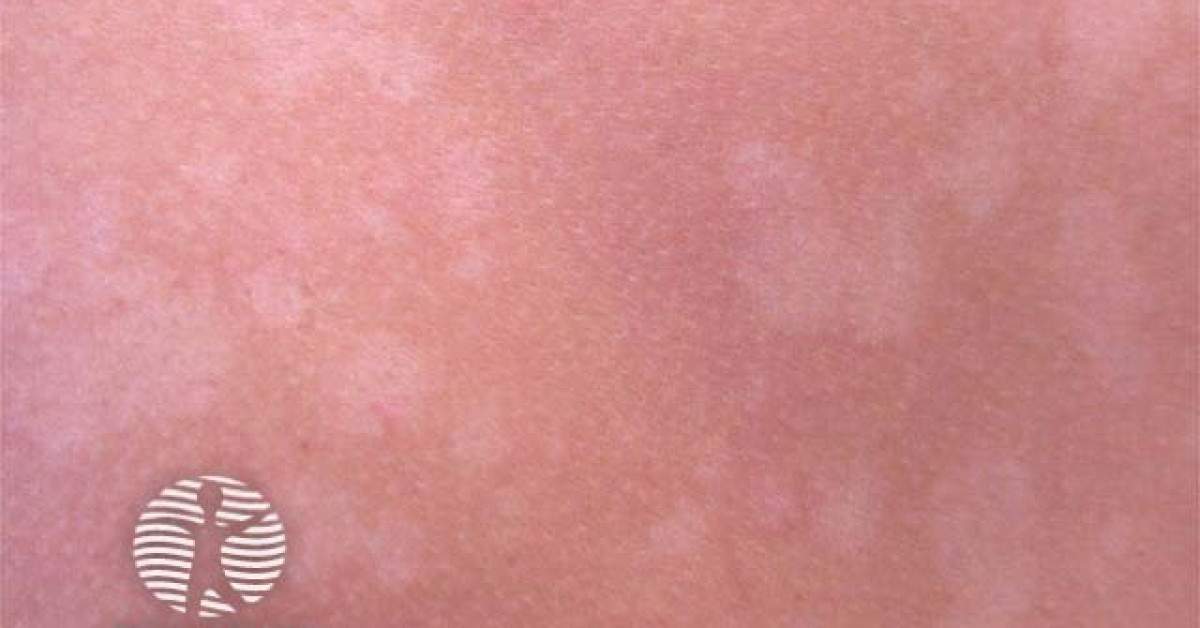 DermNet® - q11c7b image