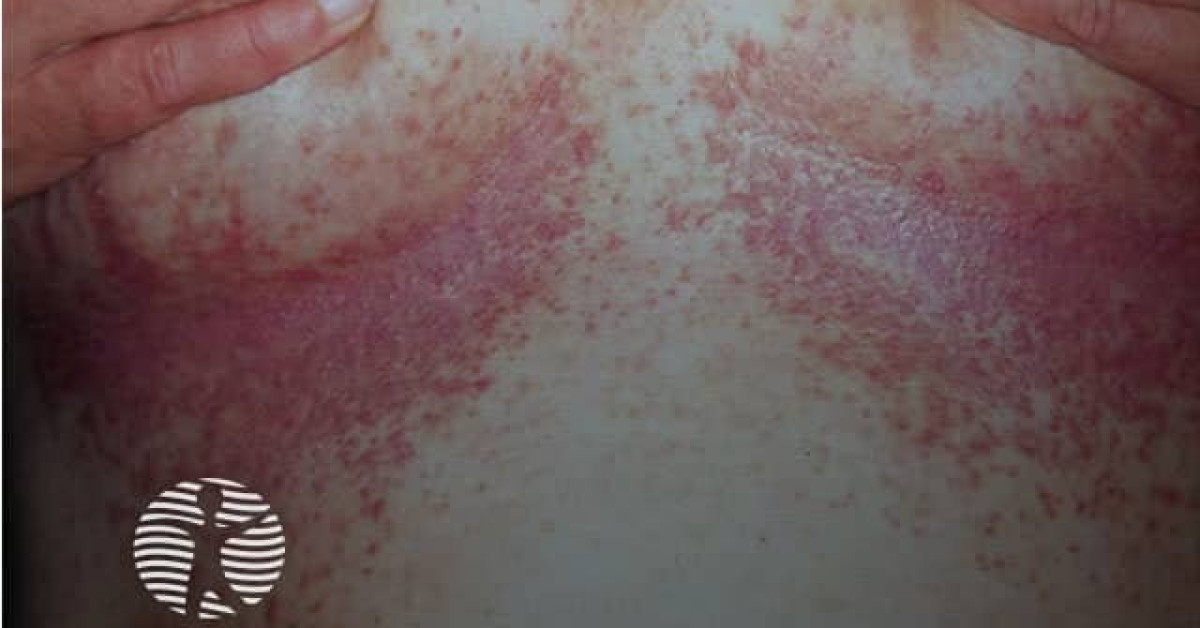 Darier disease image
