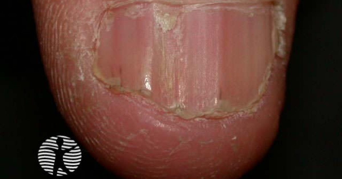 Darier disease image