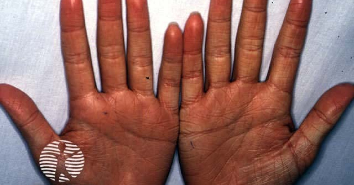 Hyperlinear palms in ichthyosis vulgaris image