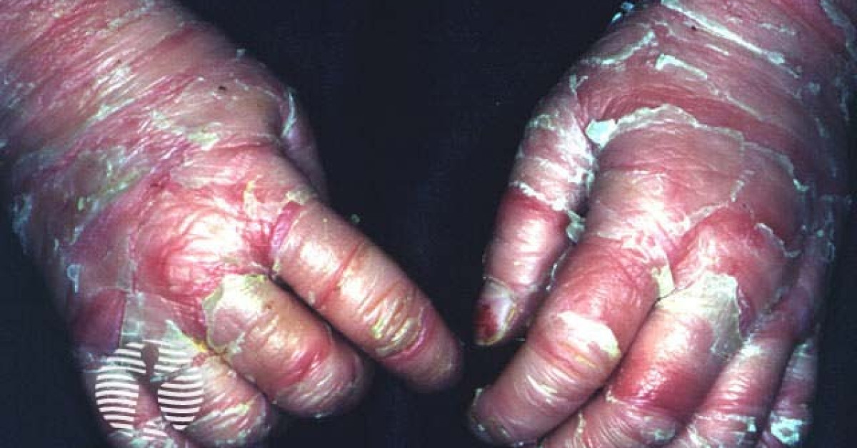 Bullous ichthyosiform erythroderma image