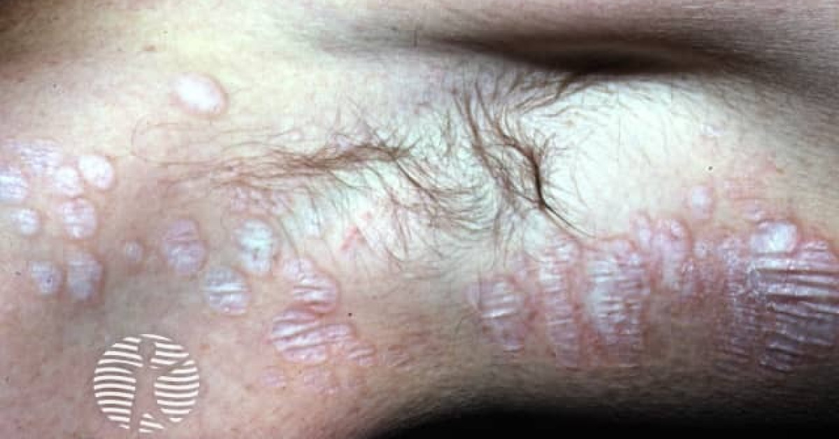 Lichen Sclerosus Image