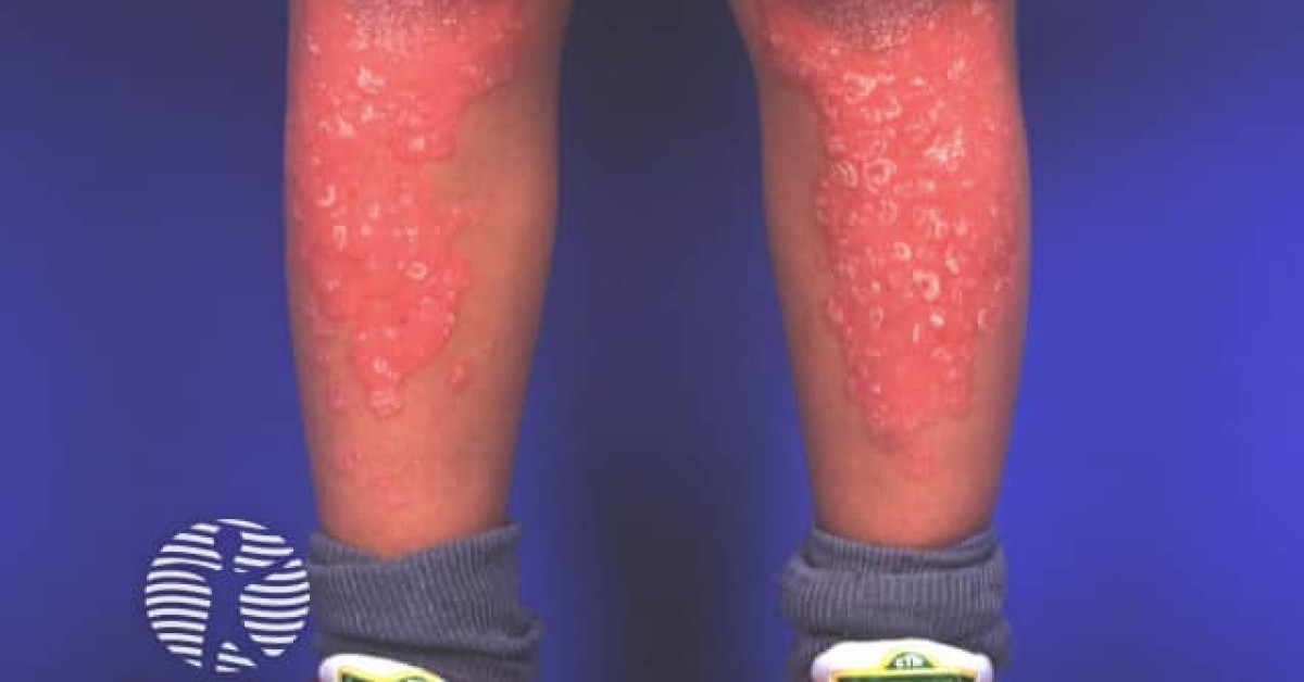 Pityriasis rubra pilaris image