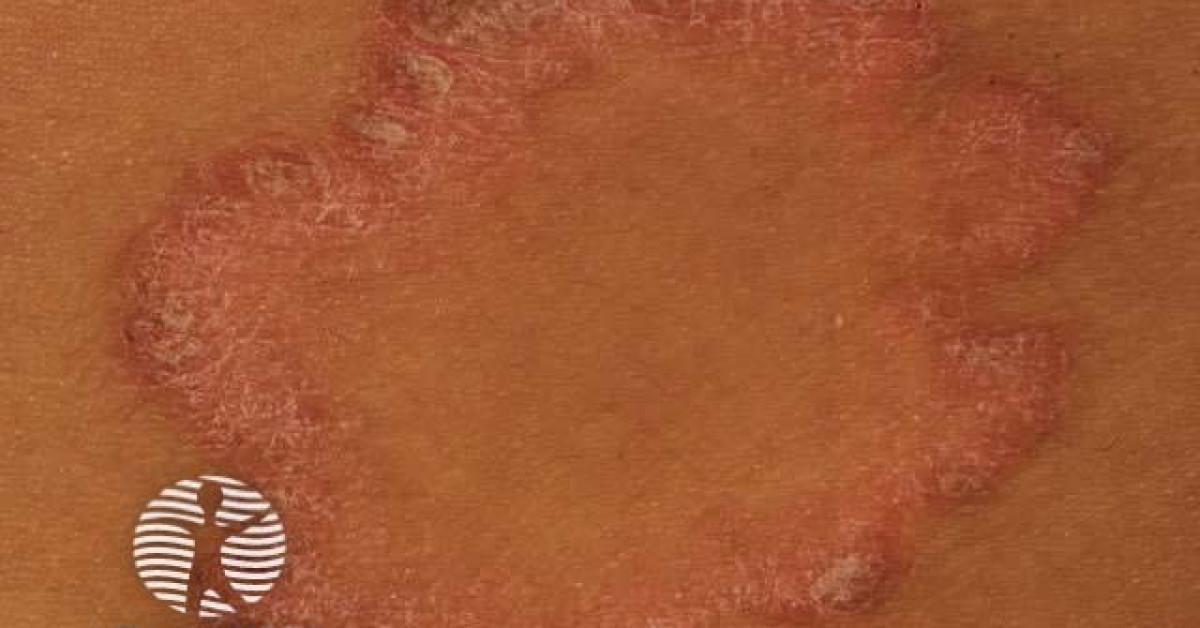 Psoriasis image