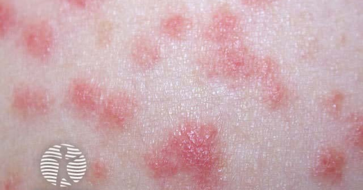 Acute guttate psoriasis image