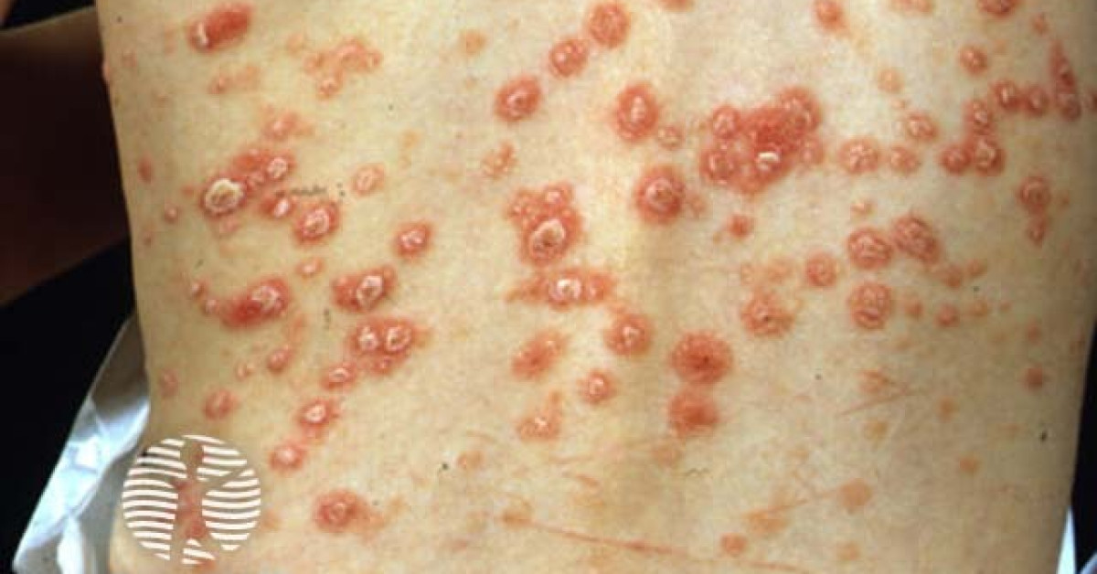Acute guttate psoriasis image