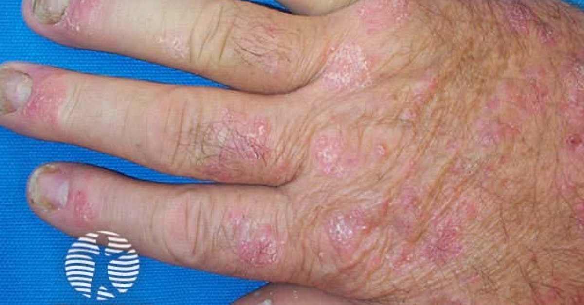 Chronic plaques of psoriasis image