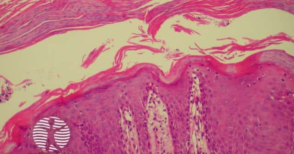 Inflammatory infiltrate in psoriasis image