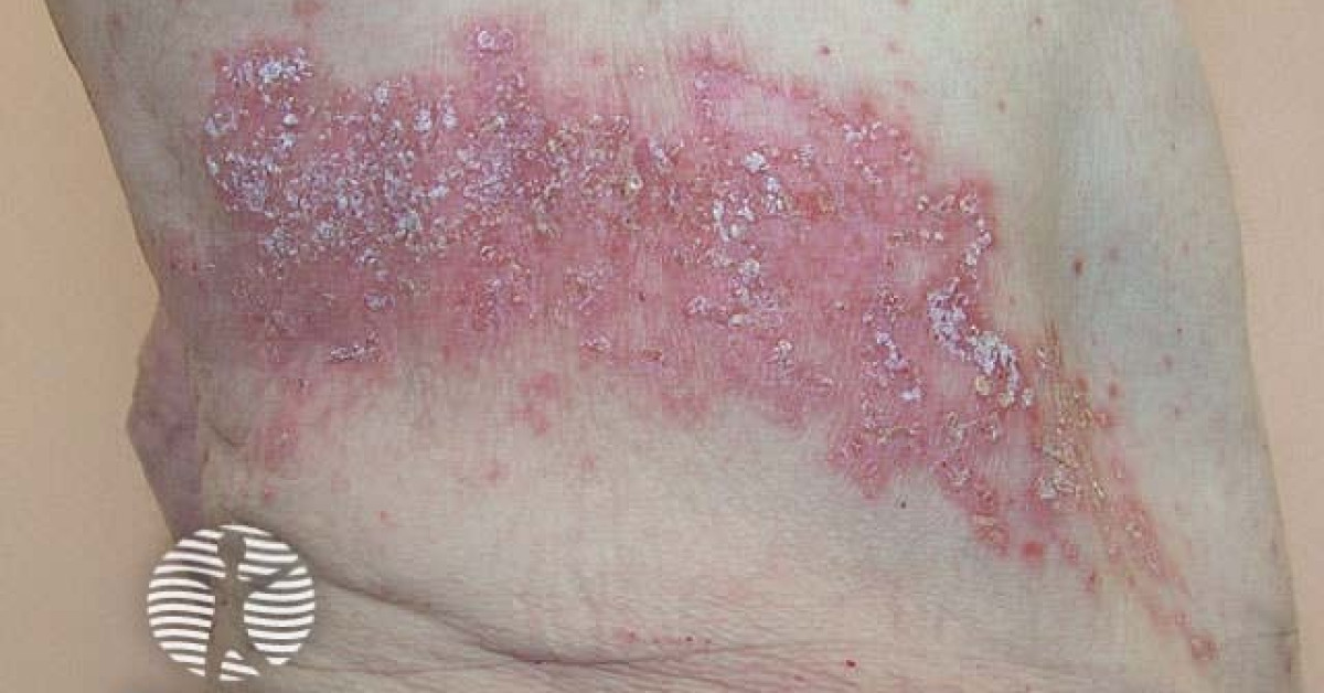 Koebnerised psoriasis image