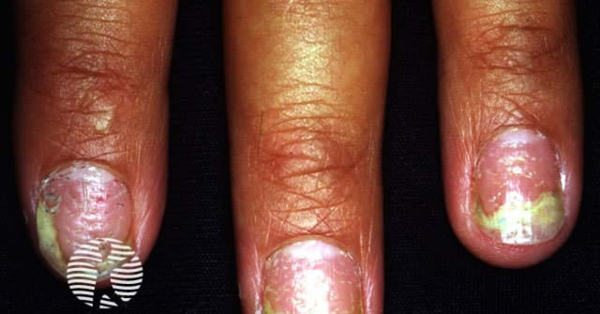 Nail psoriasis image