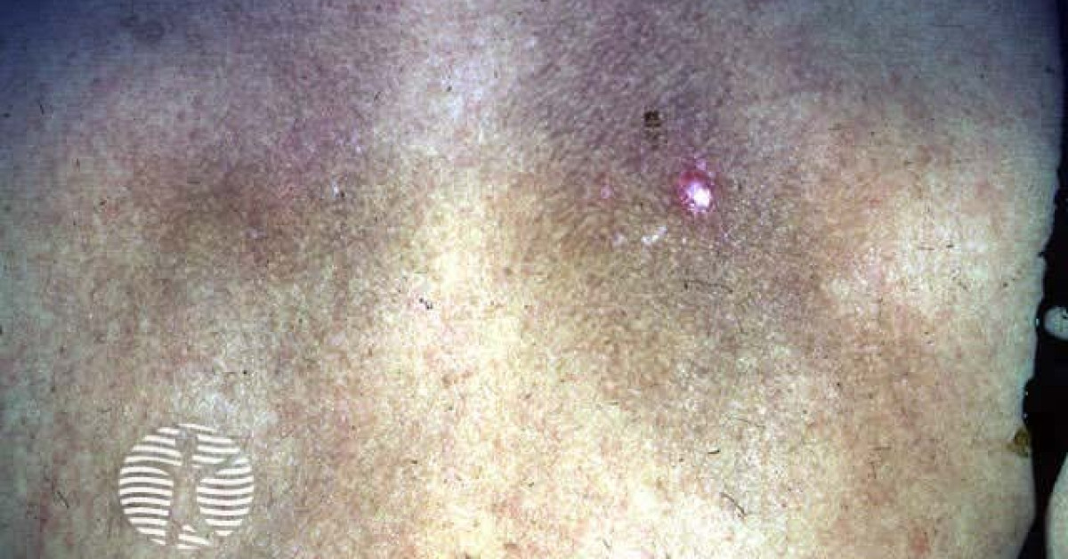 Macular cutaneous amyloidosis image