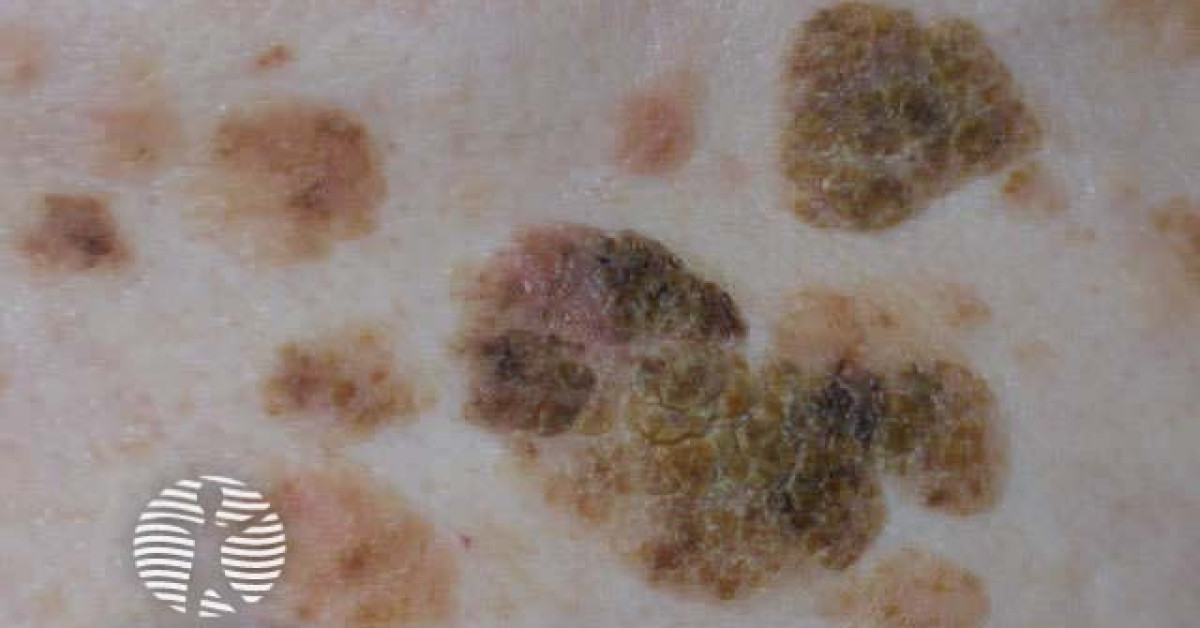 Sign of Leser Trelat: seborrhoeic keratoses image