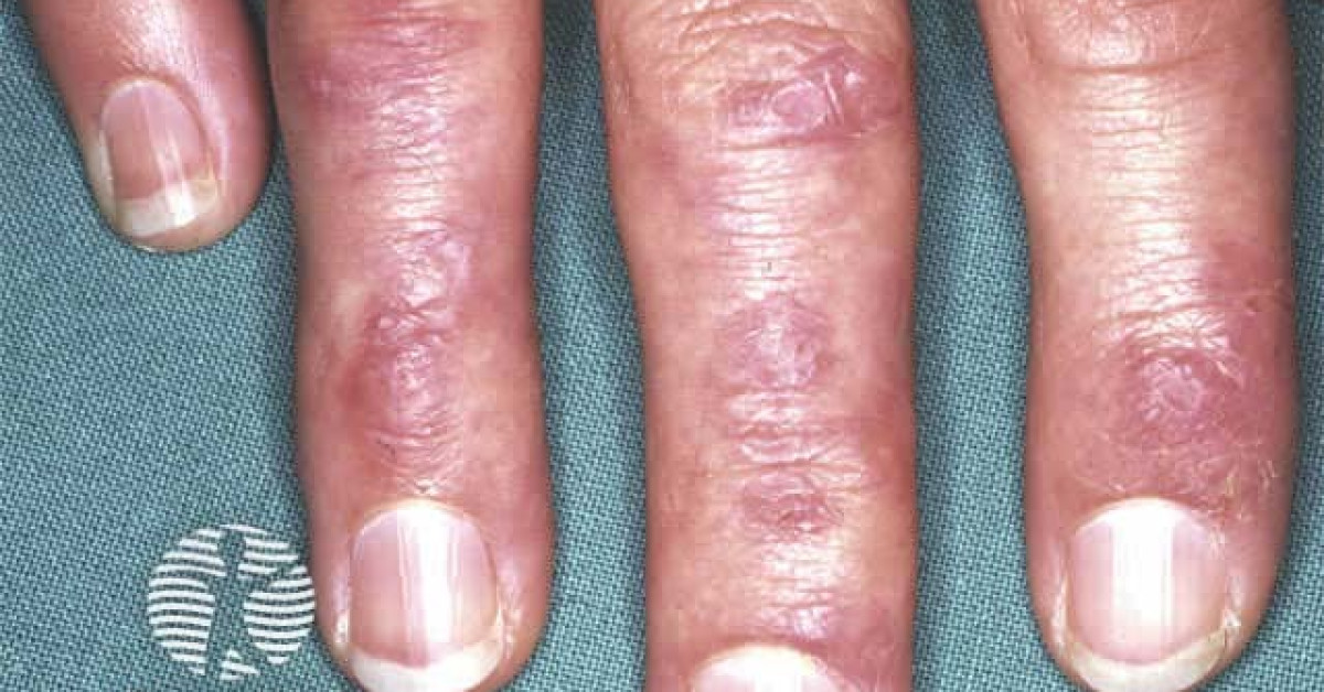 Dermatomyositis. Gottron papules image