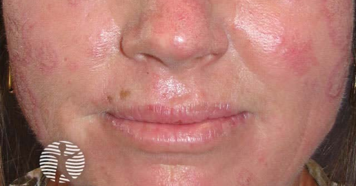 Butterfly rash. Systemic lupus erythematosus. image