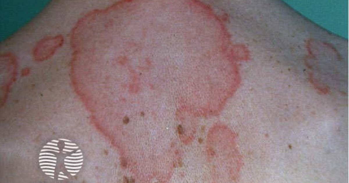 Subacute cutaneous lupus erythematosus image