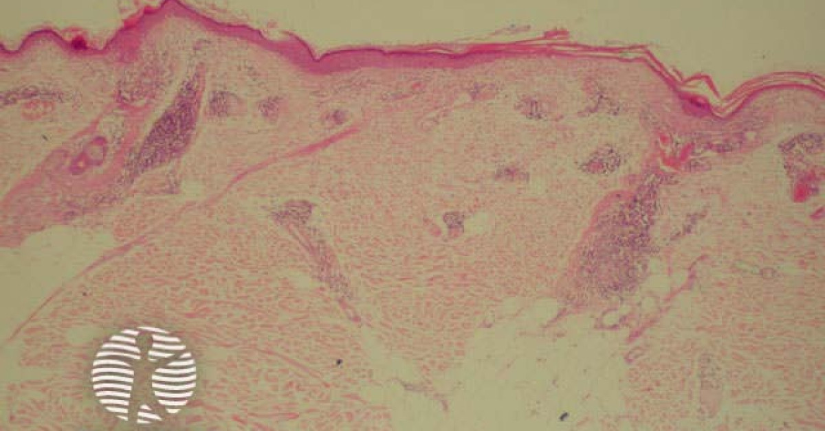 Dermatopathology of systemic lupus erythematosus image