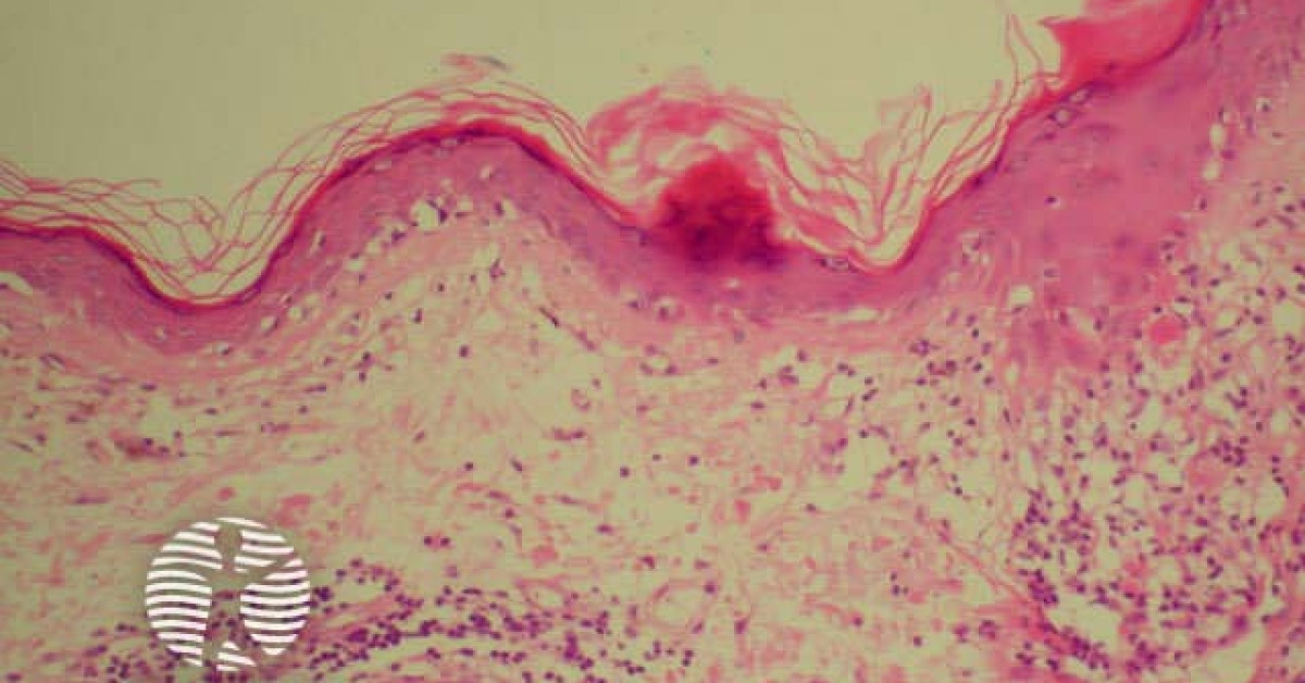 Dermatopathology of systemic lupus erythematosus image