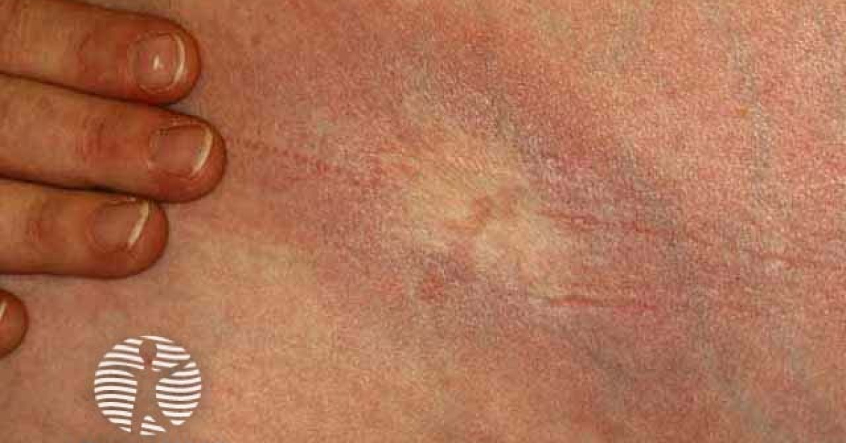 Linear morphoea image