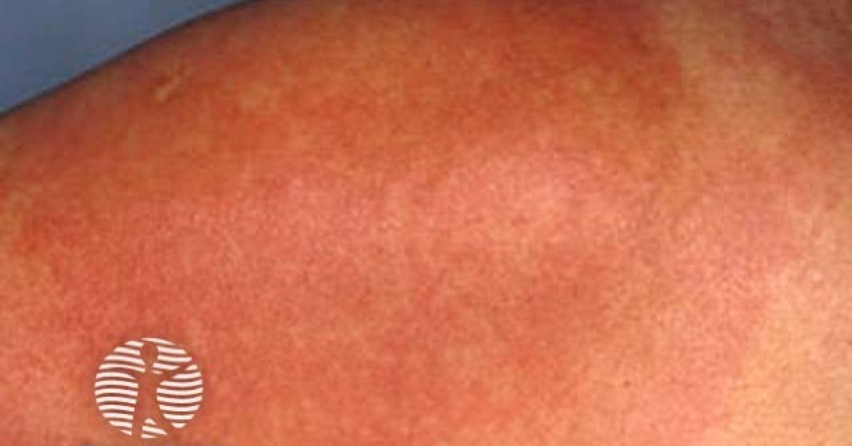 Erythema migrans image