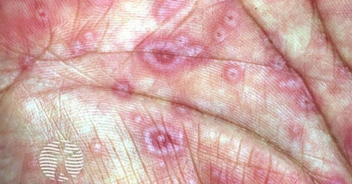 Erythema multiforme minor image