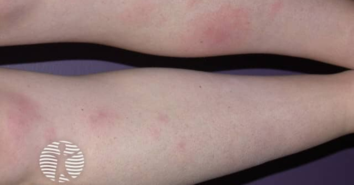 Erythema nodosum image