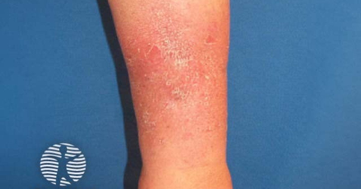 Pretibial myxoedema image