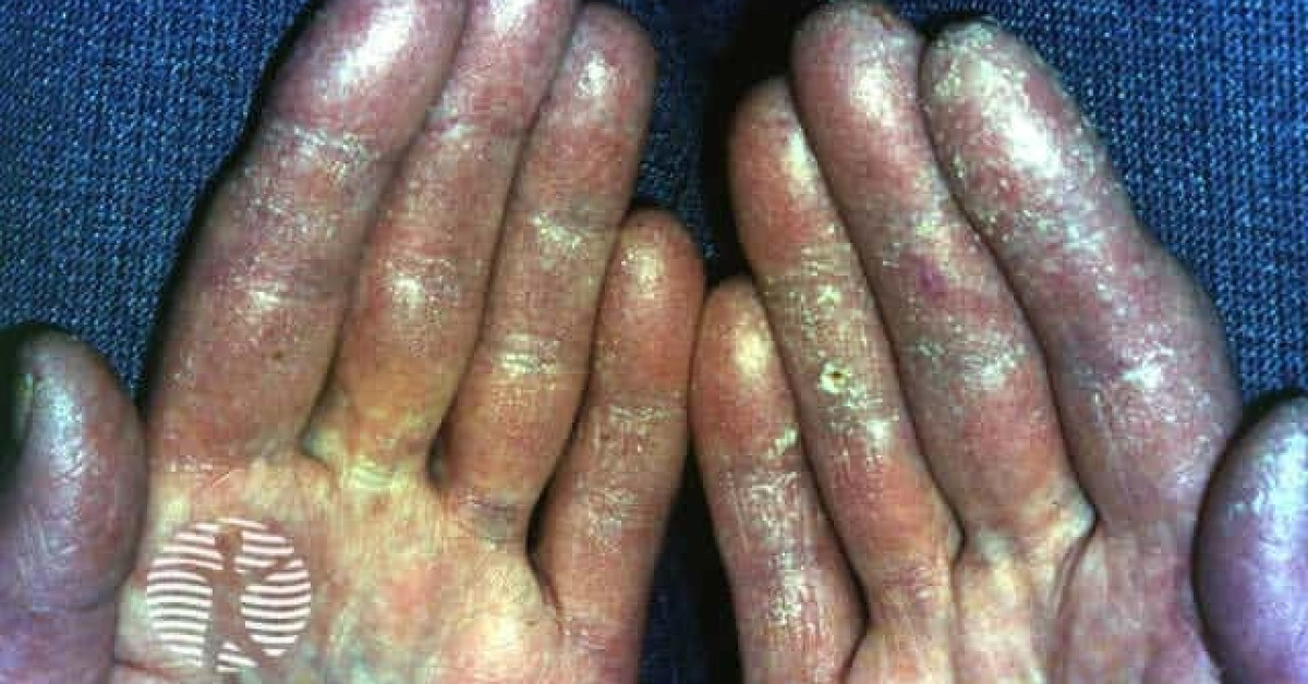 Paraneoplastic acrokeratosis (Bazex syndrome) image