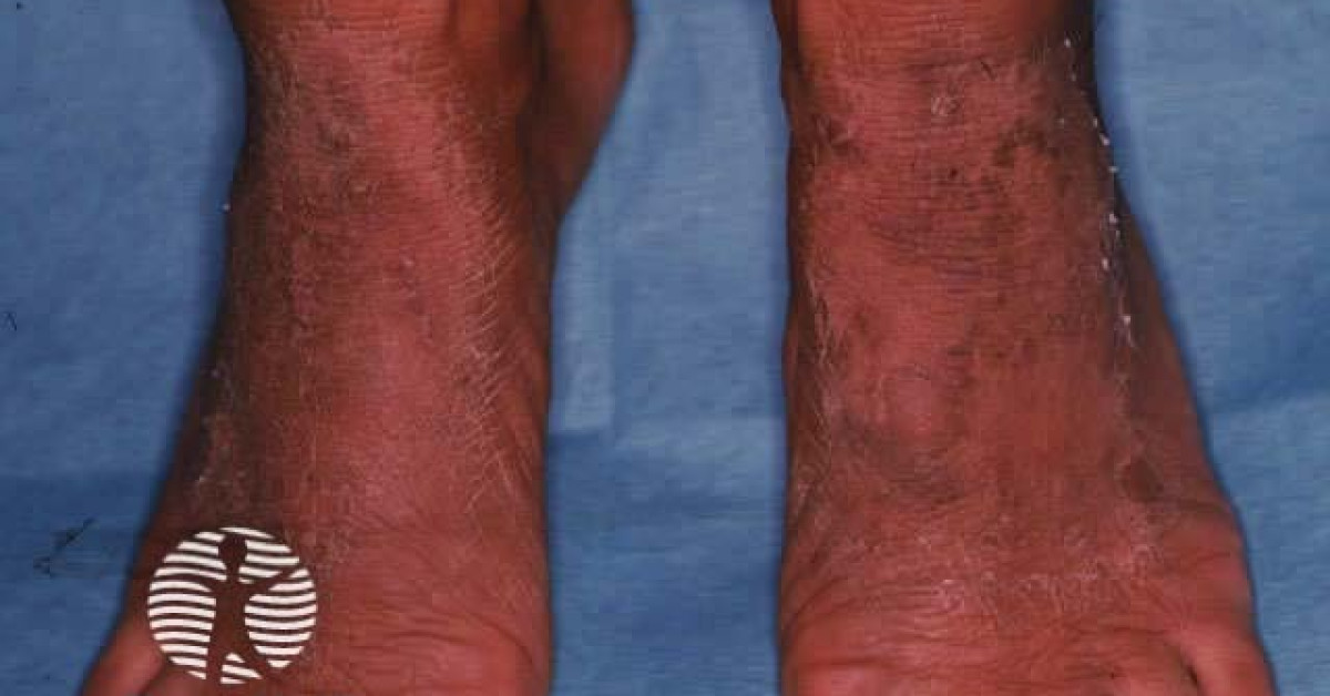 Pellagra image