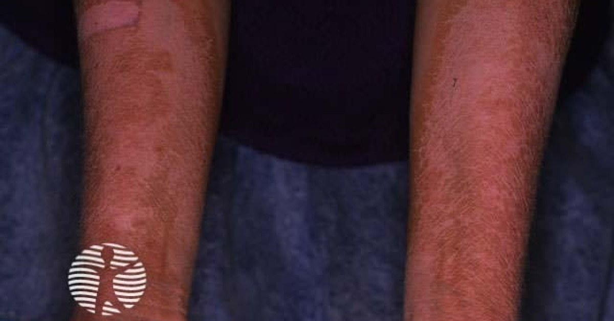 Pellagra image