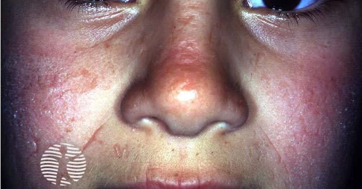 Erythropoeitic protoporphyria image