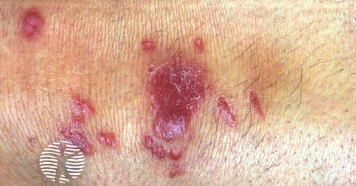 Scar sarcoidosis image