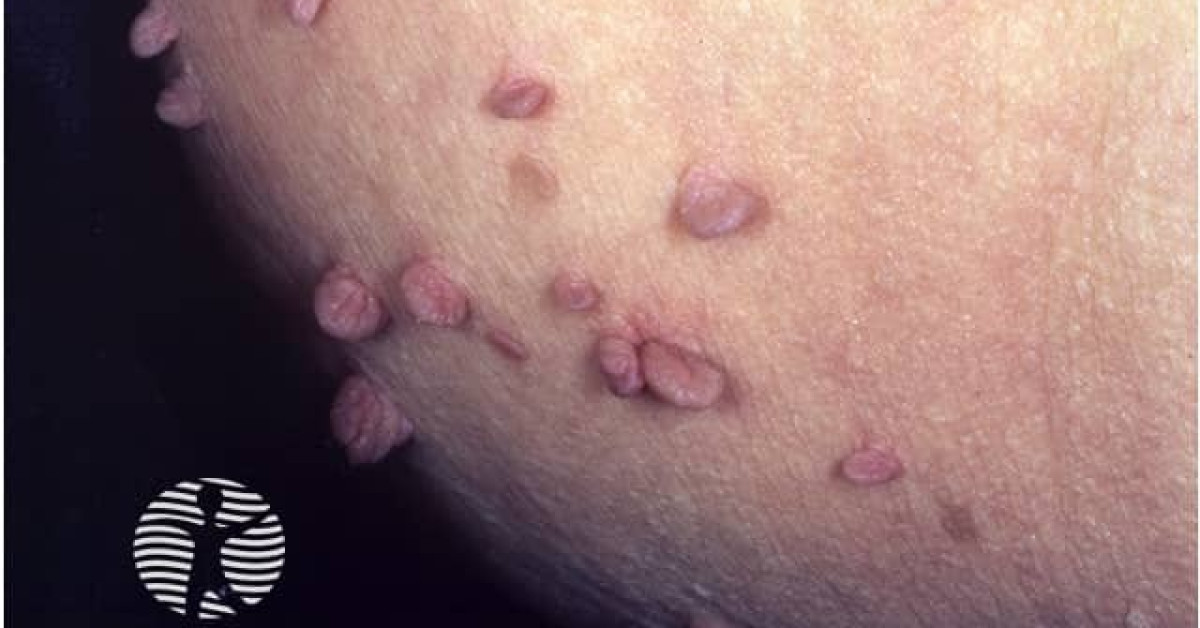 Neurofibromatosis: skin tags image