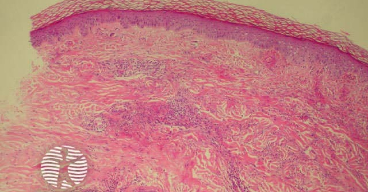 Dermatopathology of hypersensitivity vasculitis image