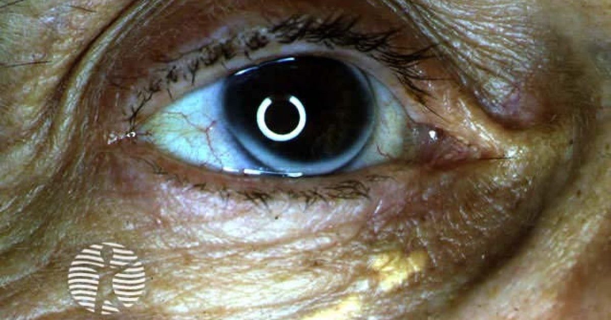 DermNet® - Xanthelasma image