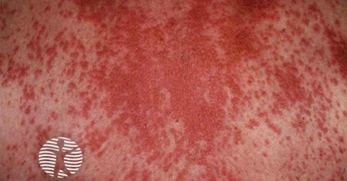 Eruptive xanthomata image