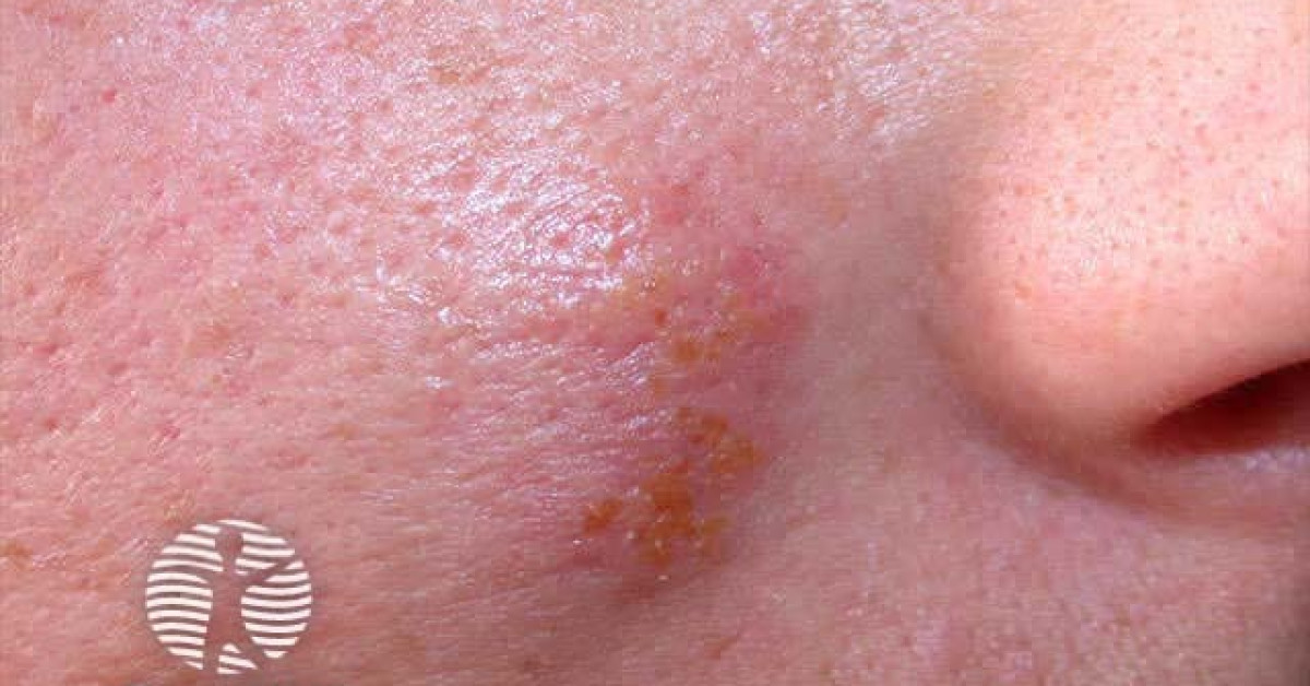 Recurrent facial herpes image