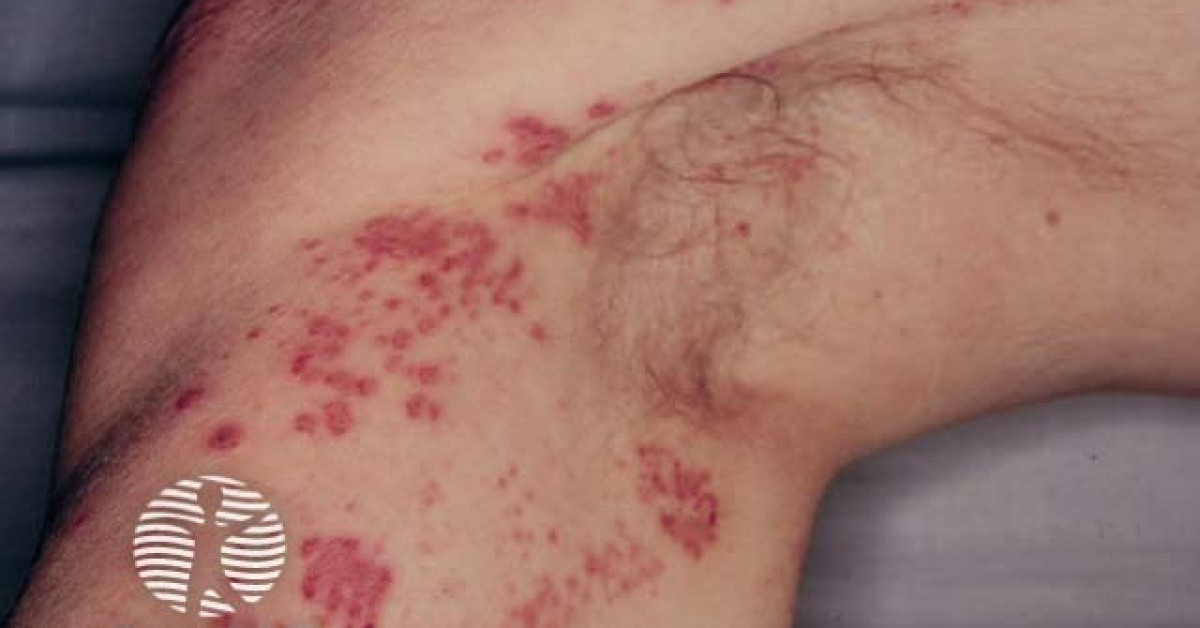 Herpes zoster image
