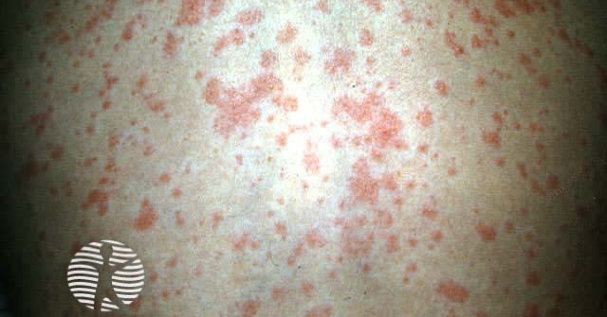 Measles exanthem image