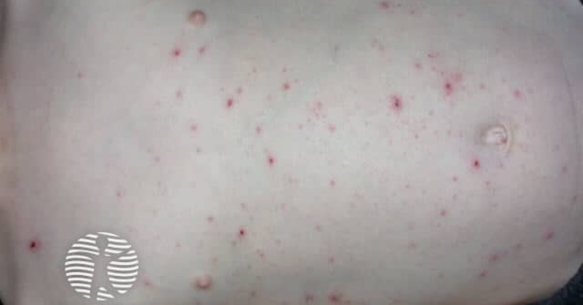 Varicella image