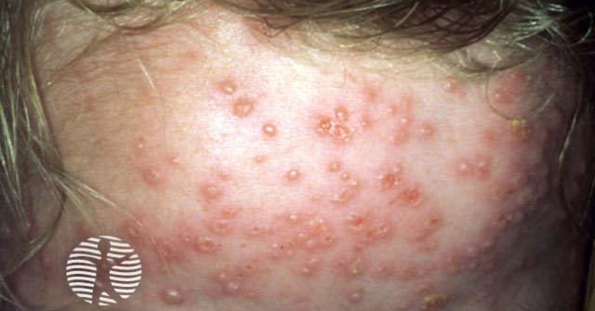 Varicella vesicles image